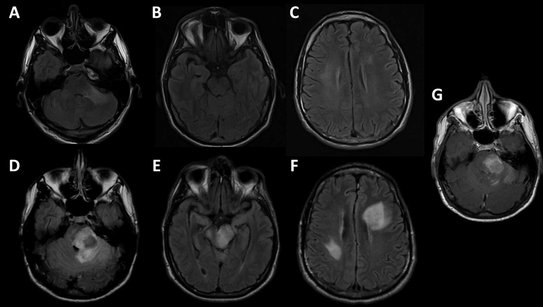 Brain tumour mimics and chameleons | Practical Neurology