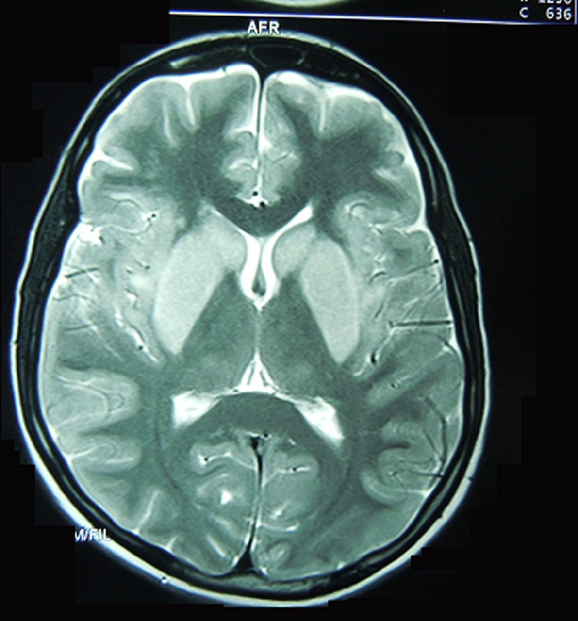 Toxic encephalopathy due to colchicine—Gloriosa superba poisoning ...