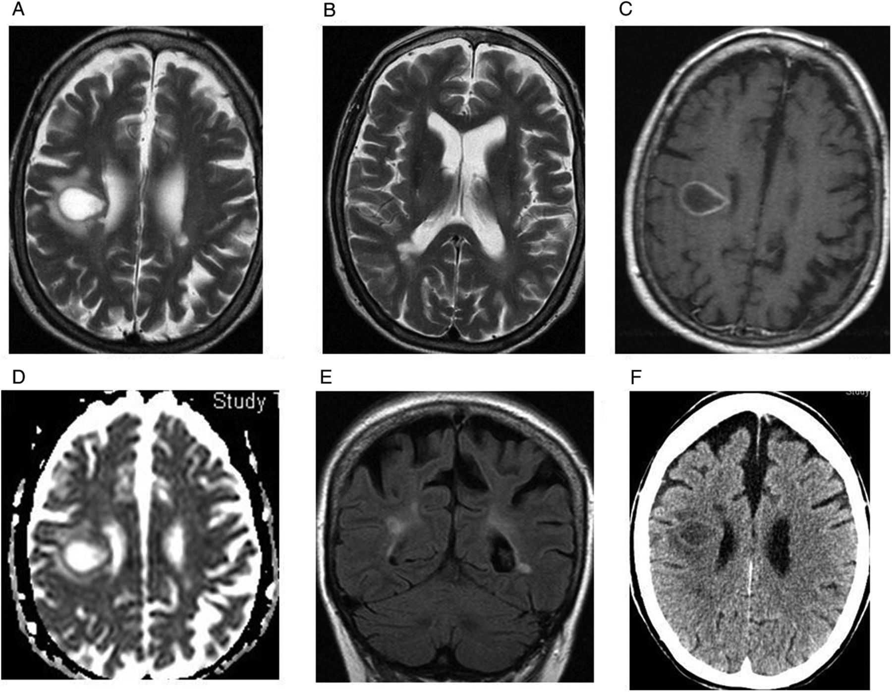 Imaging in multiple sclerosis and related disorders | Practical Neurology
