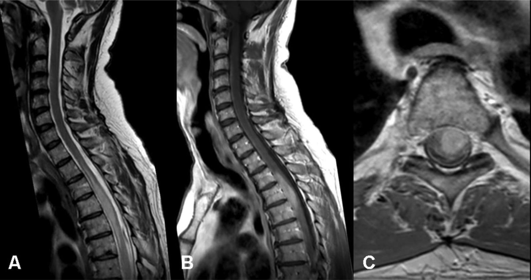Cervical Spine Mri Without Contrast
