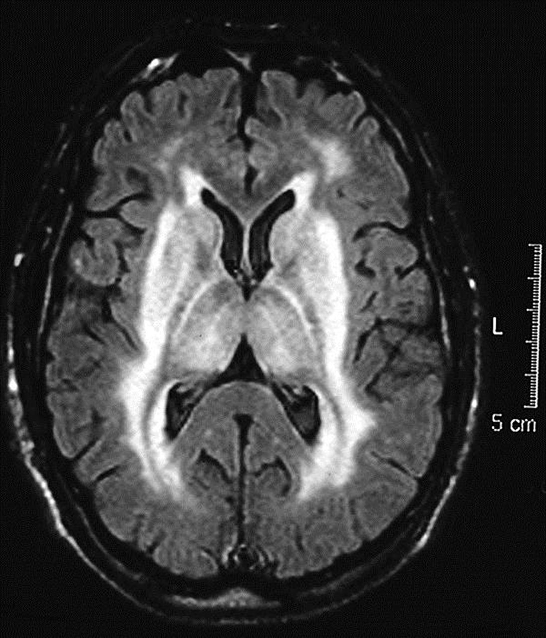 Gordon Holmes syndrome: finally genotype meets phenotype | Practical ...