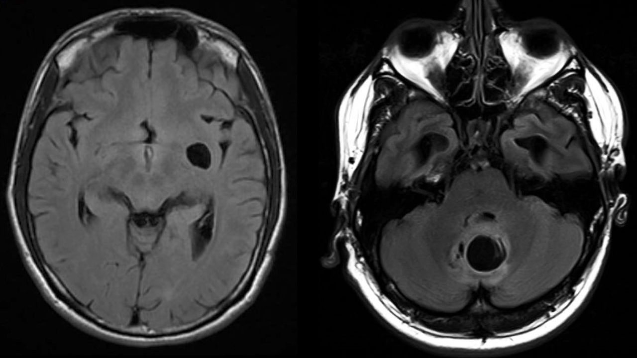 Neurocysticercosis
