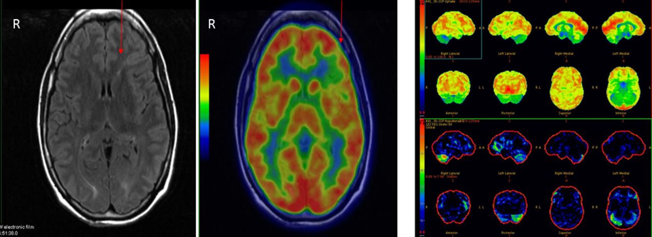 Brain Imaging In Epilepsy Practical Neurology Brain Imaging In Epilepsy Practical Neurology