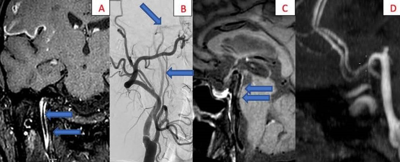 Black blood imaging of intracranial vessel walls | Practical Neurology