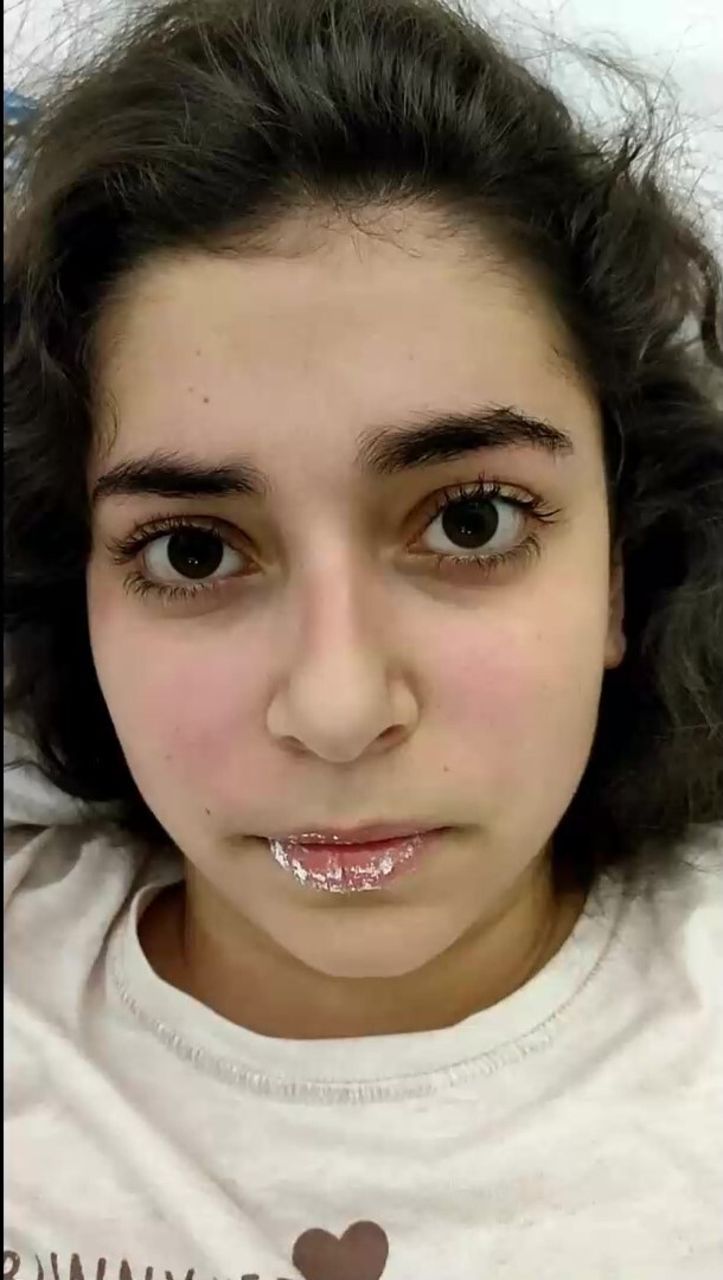 Oculogyric crisis: the girl who stared at the ceiling | Practical Neurology