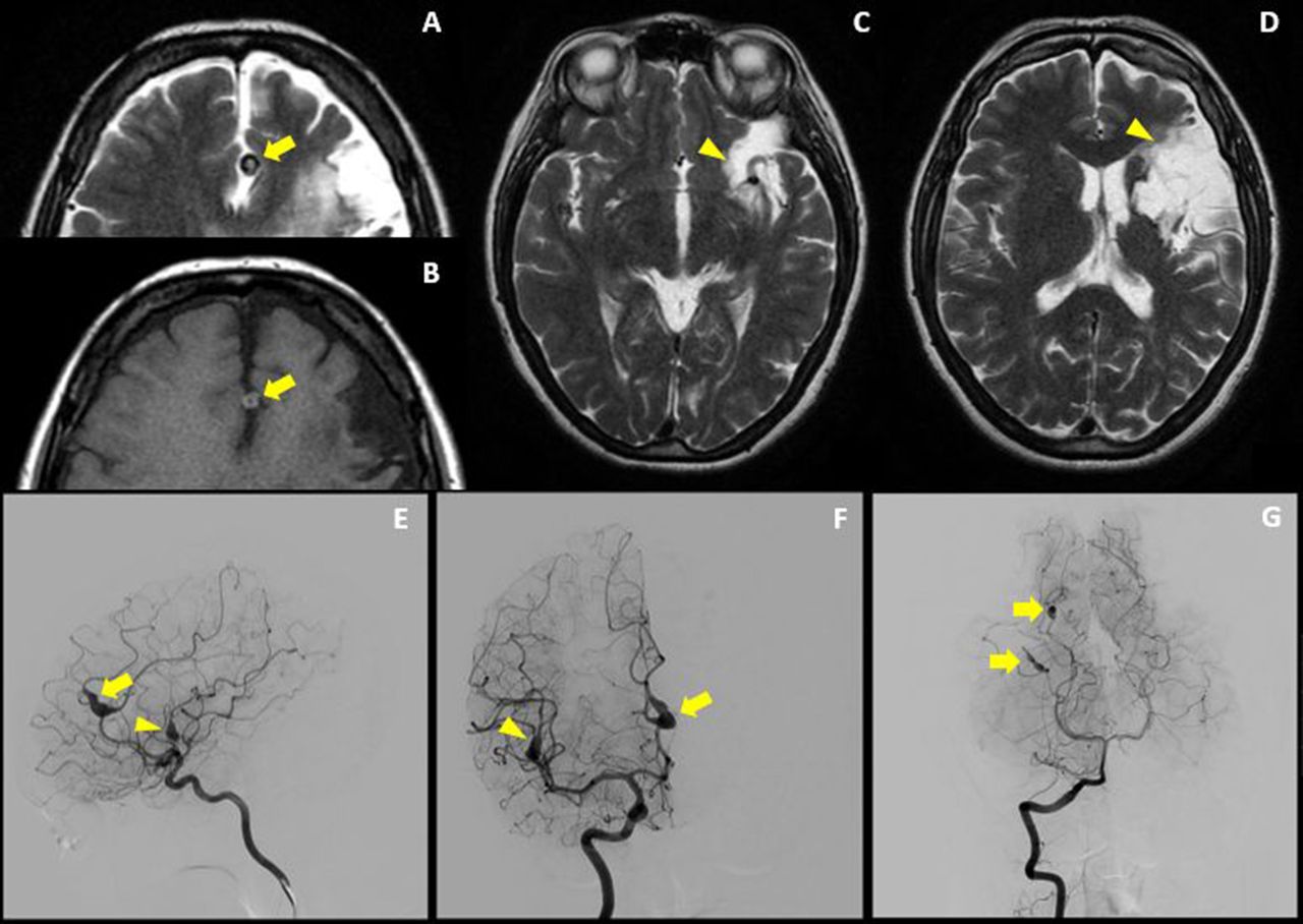 Multiple intracranial aneurysms years after cardiac myxoma resection ...