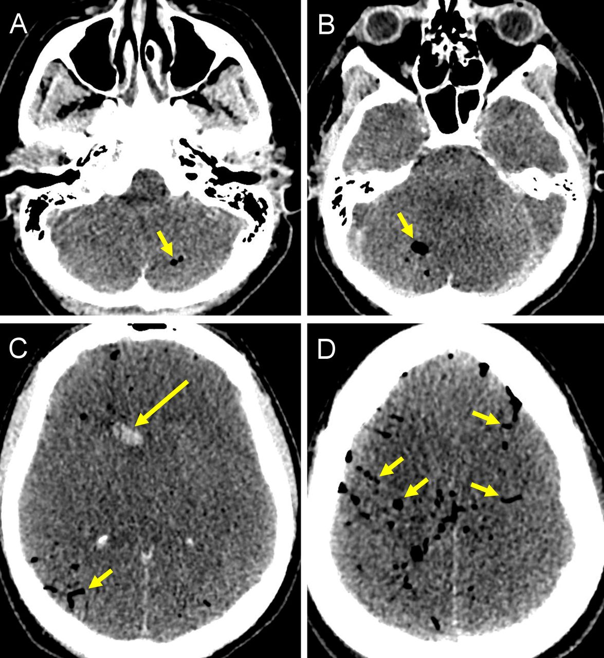 Fatal cerebral air embolism from atrio-oesophageal fistula following ...
