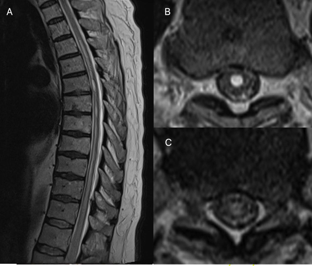 Spinal dural arteriovenous fistula | Practical Neurology