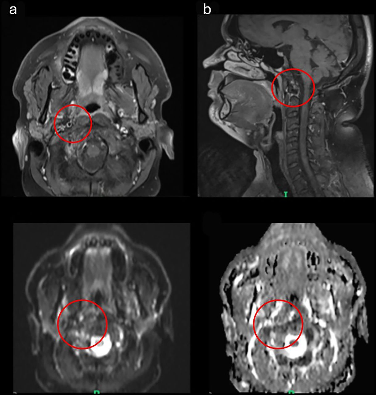 Occipital condyle syndrome: a rare manifestation of skull base ...